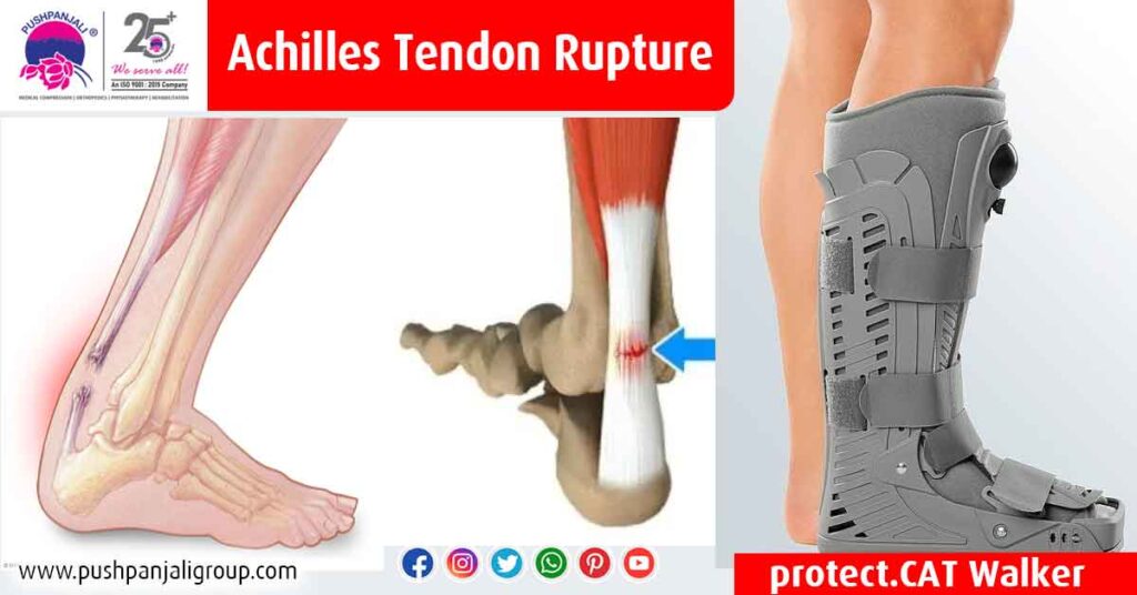 The perils of Achilles Tendon rupture, foot, and joint fractures ...